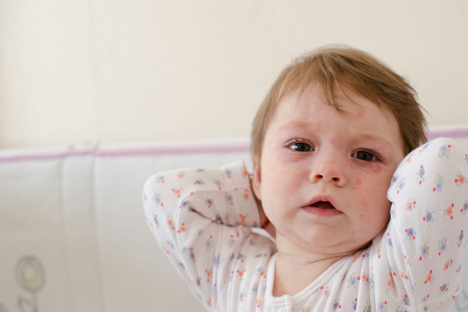 Roséole : comment la reconnaître et comment la traiter