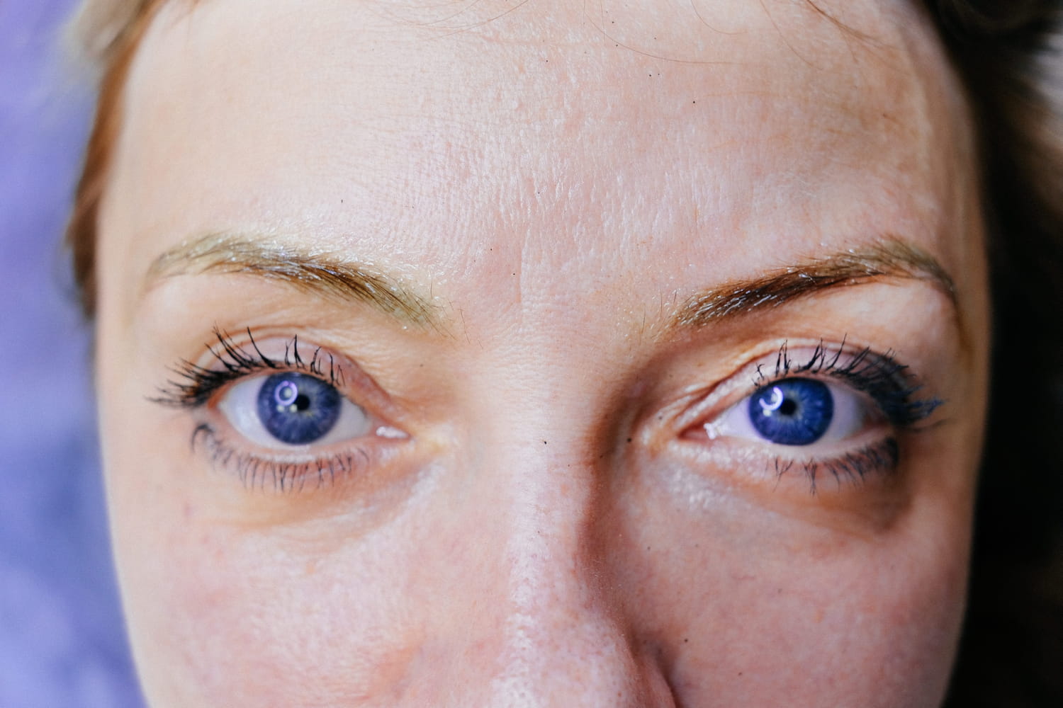 Orgelet à l'oeil : bouton blanc, causes, contagieux