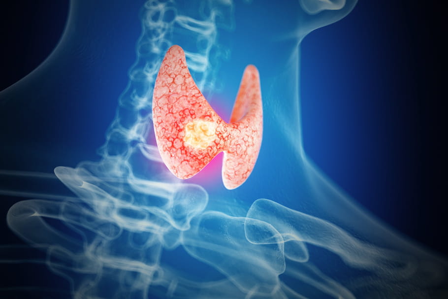 Hyperthyroïdie : reconnaître les signes et la soigner