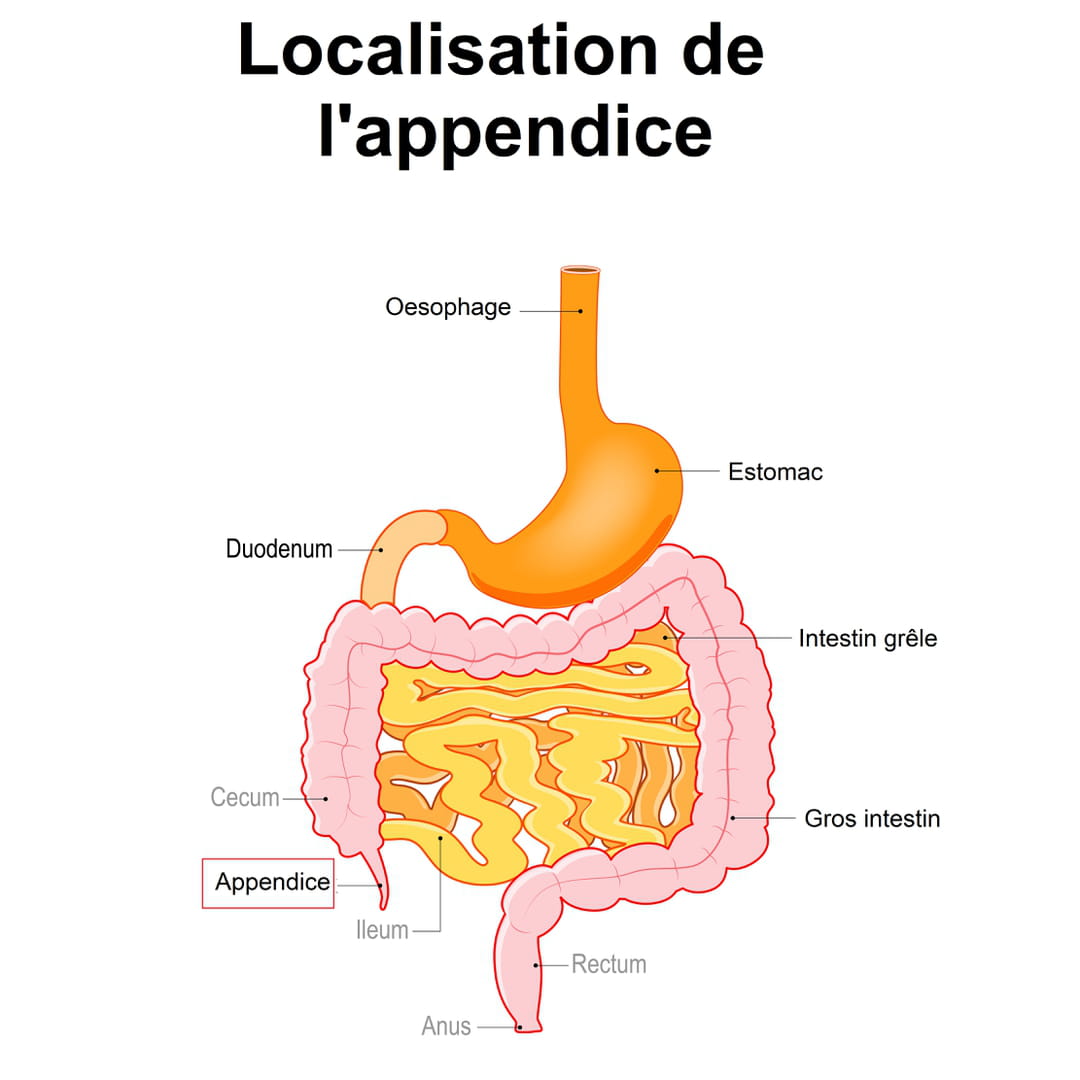 L appendicite Traitement Naturel L appendicite Traitement Naturel