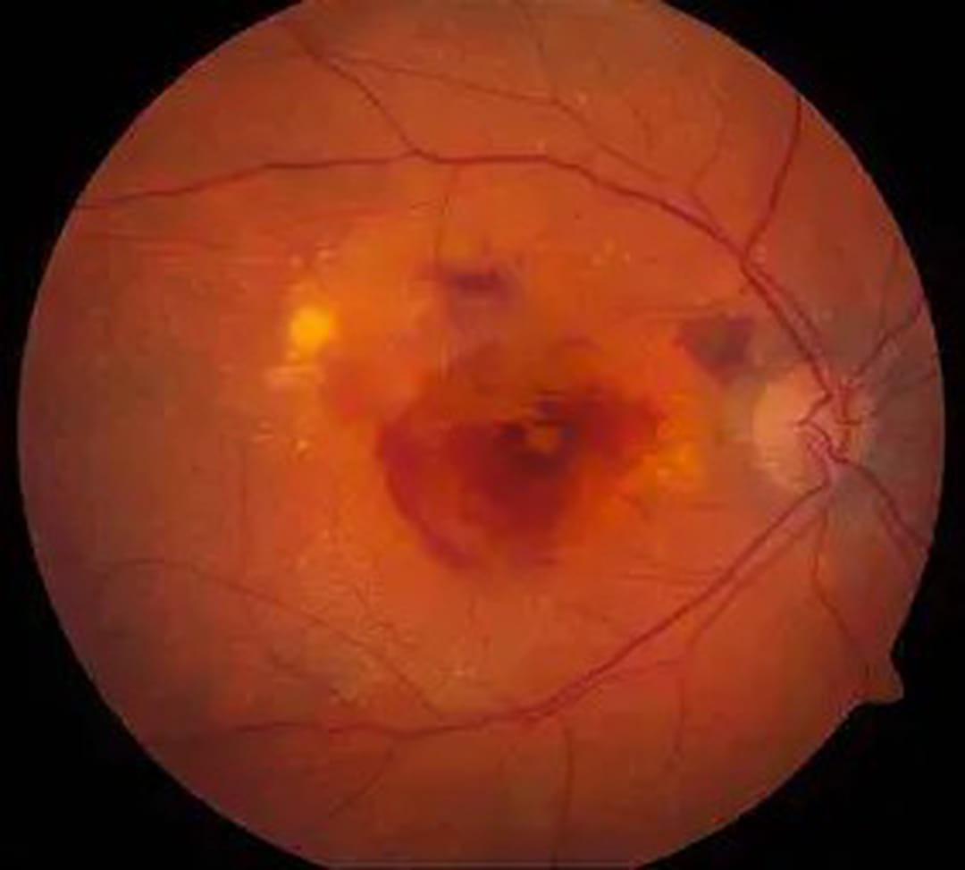 DMLA (sèche, humide) : symptômes, traitements pour les yeux