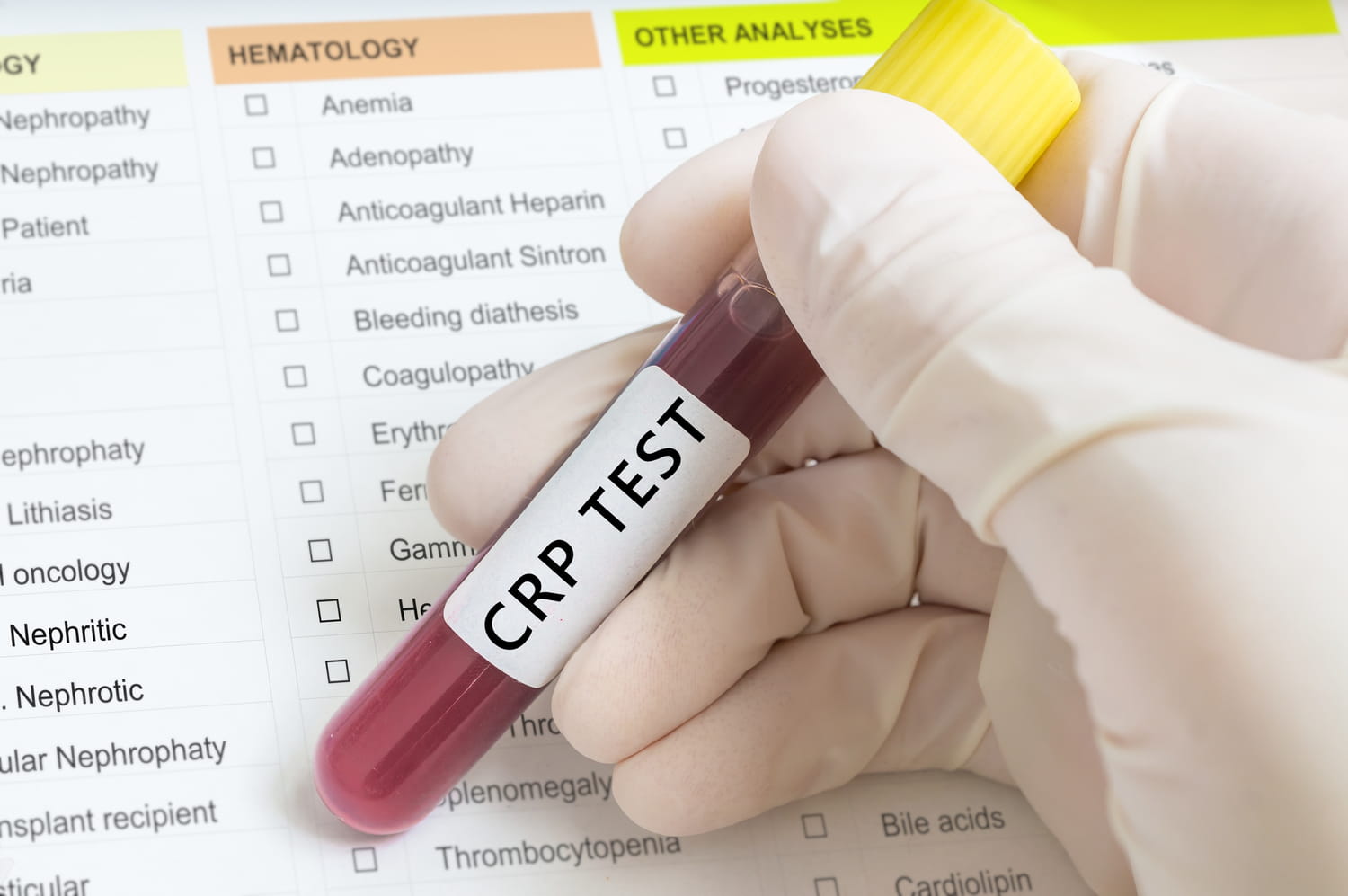 Prot ine C r active CRP lev e Causes Inqui tant Prot ine C r active CRP lev e Causes Inqui tant